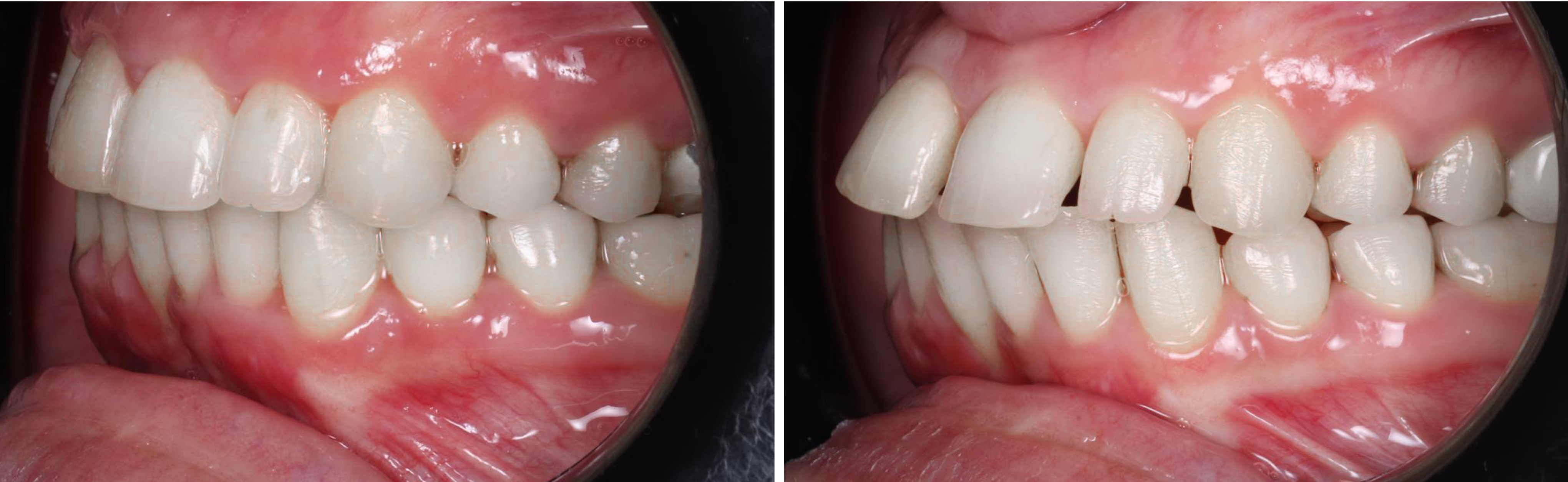 Class II Malocclusion with Clear Aligners: How to Successfully Treat Your Patients
